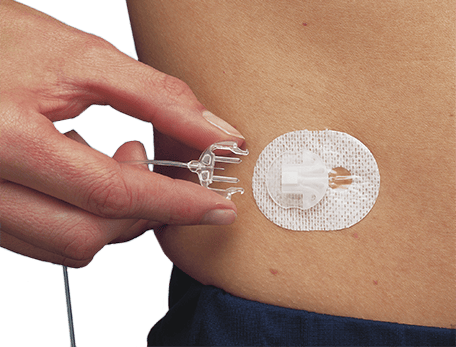 Infusion Sets For Insulin Delivery | Medtronic Diabetes